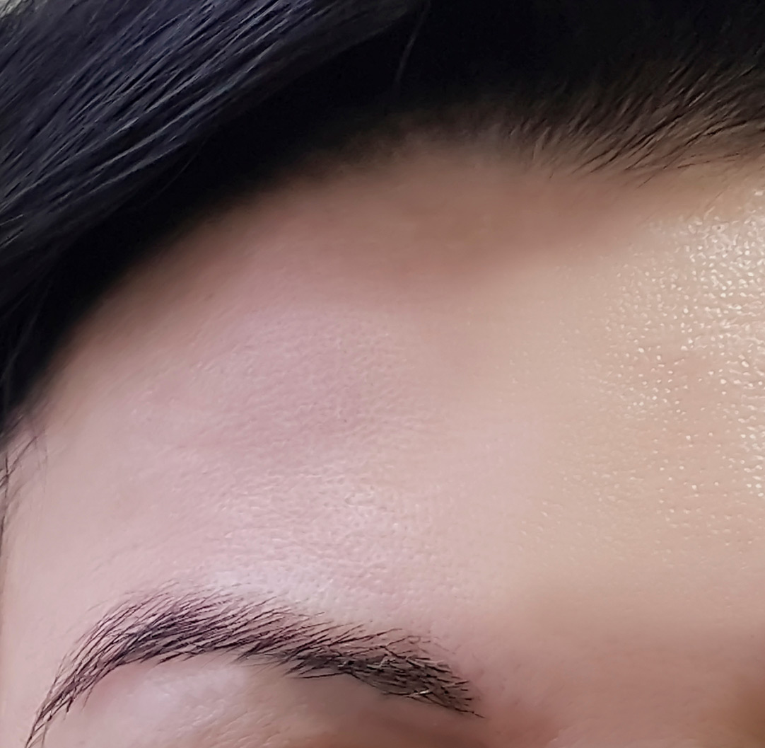 Discover Botox: The Key To Youthful, Revitalized Skin