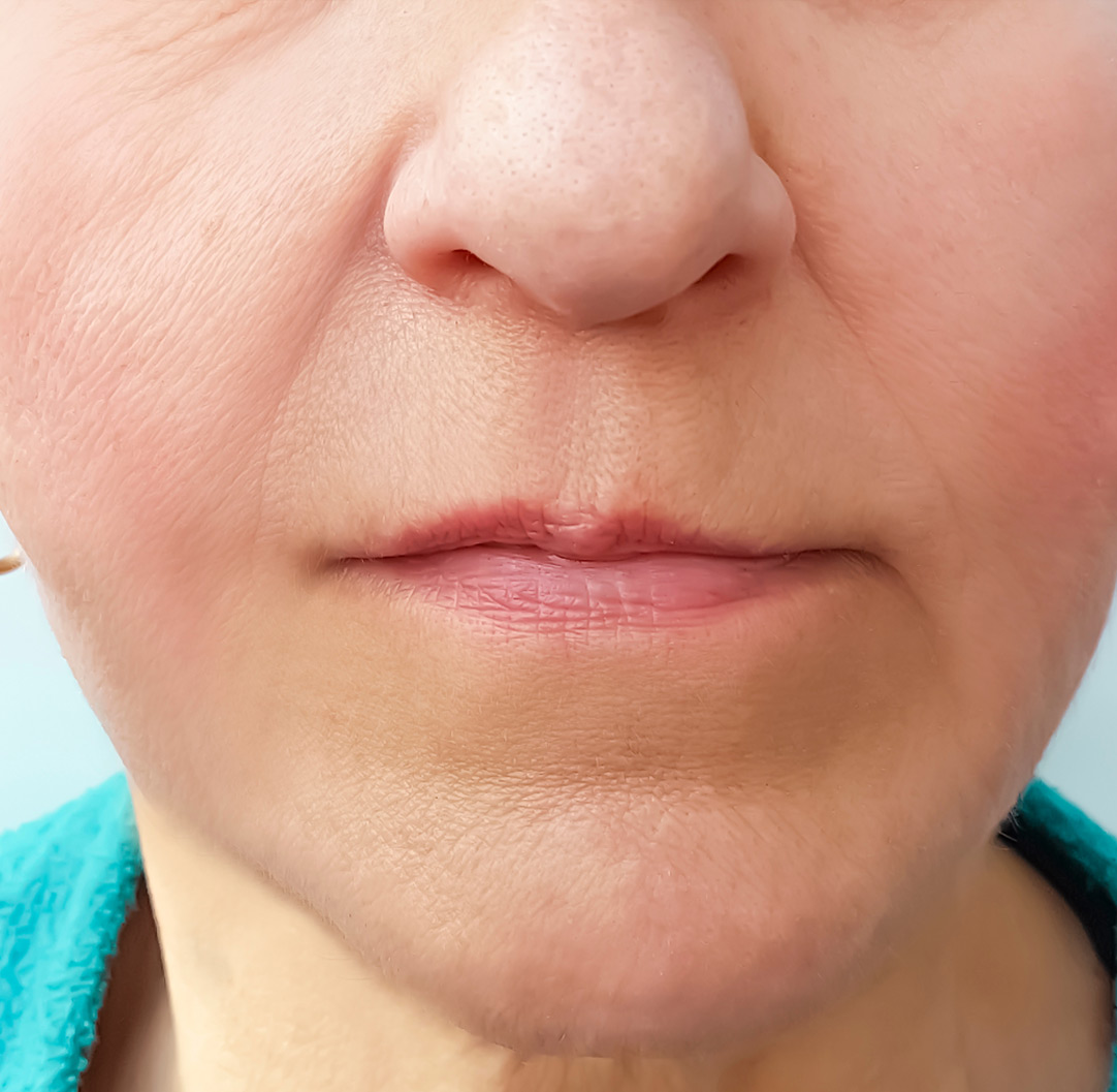 Discover Botox: The Key To Youthful, Revitalized Skin