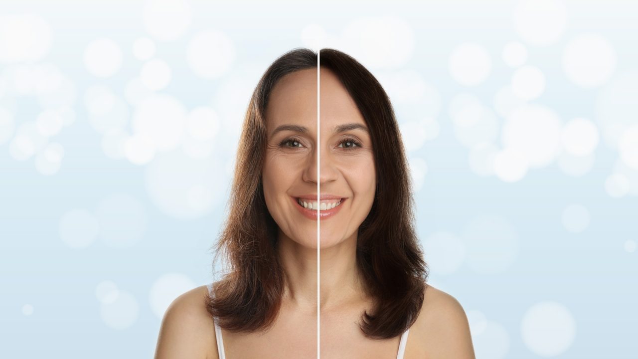 Botulinum Toxin | MHM Aesthetics