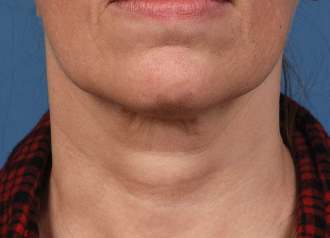 SkinPen | MHM Aesthetics